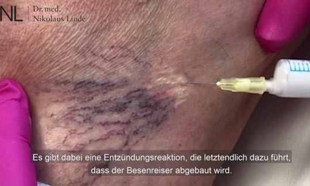 Veröden von Besenreiser – Ablauf der Behandlung | VENENCLINIC